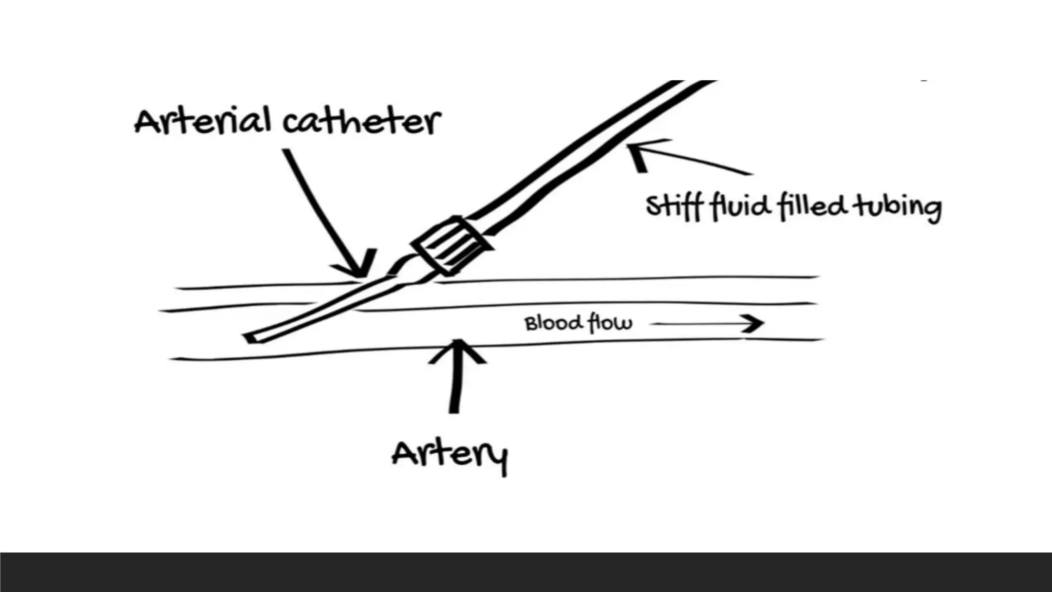 arterial line insertion in paediatric practice | PPTX