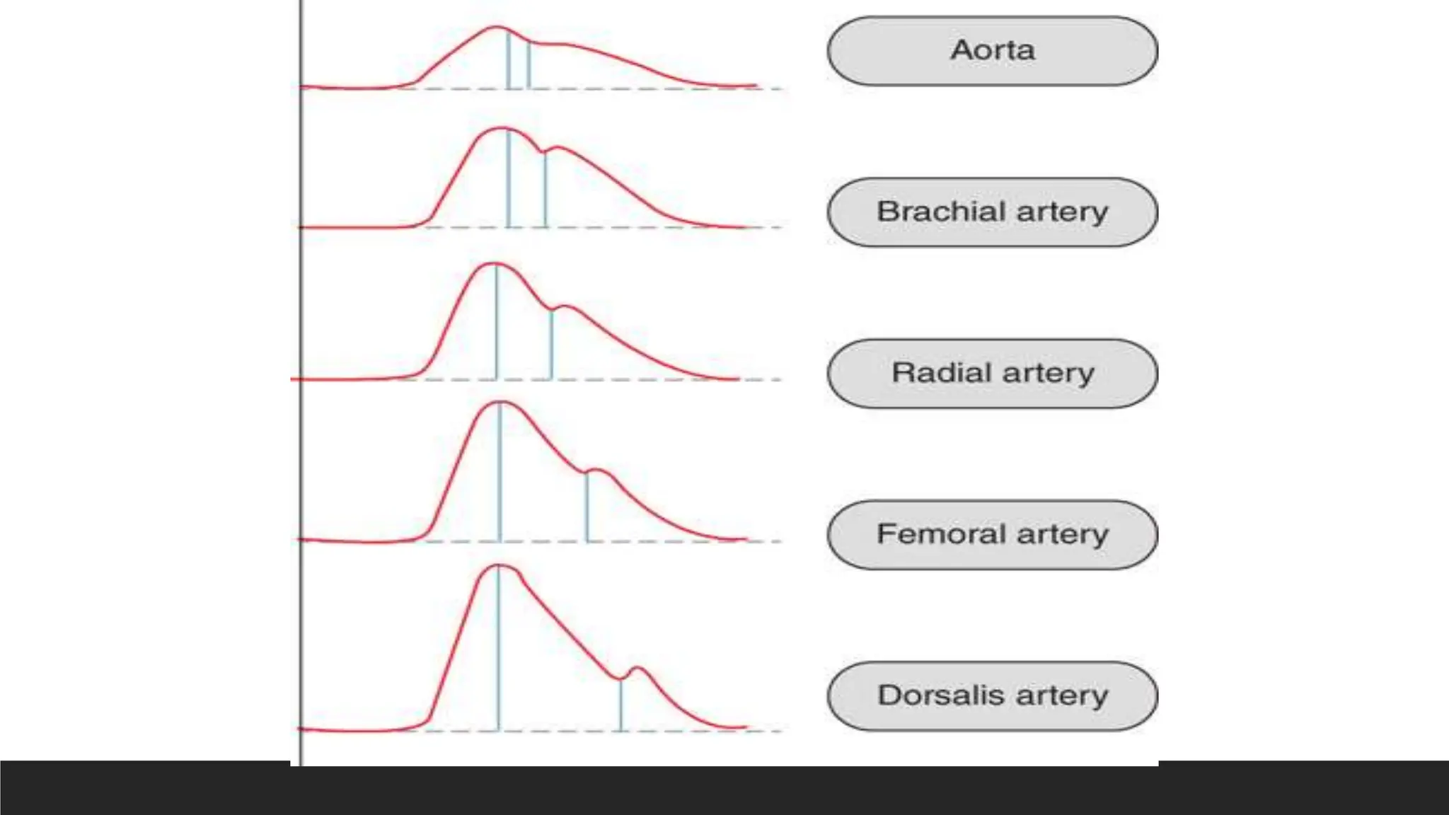 arterial line insertion in paediatric practice | PPTX