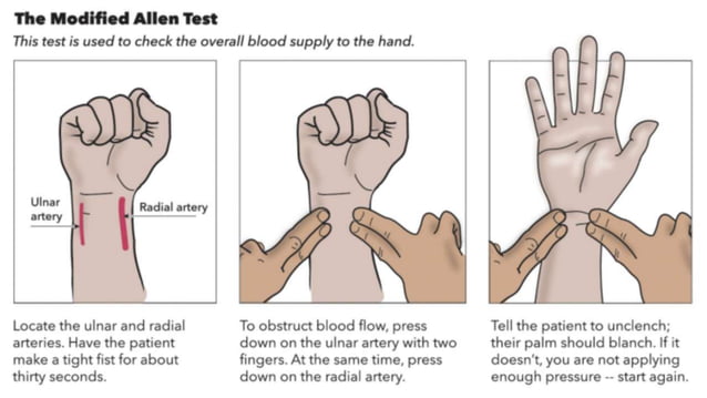 arterial line insertion in paediatric practice | PPTX | Heart and ...