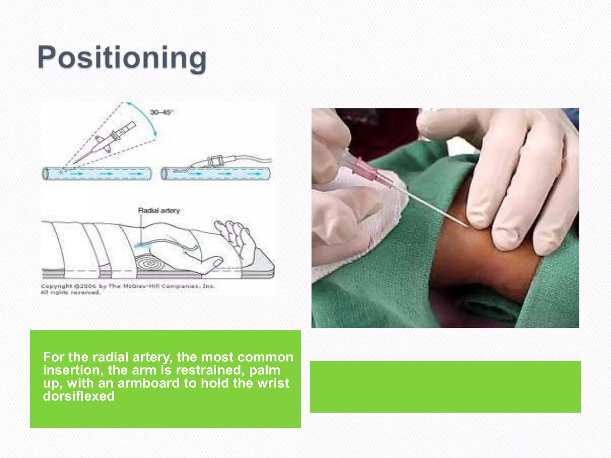 Arterial line insertion | PPTX