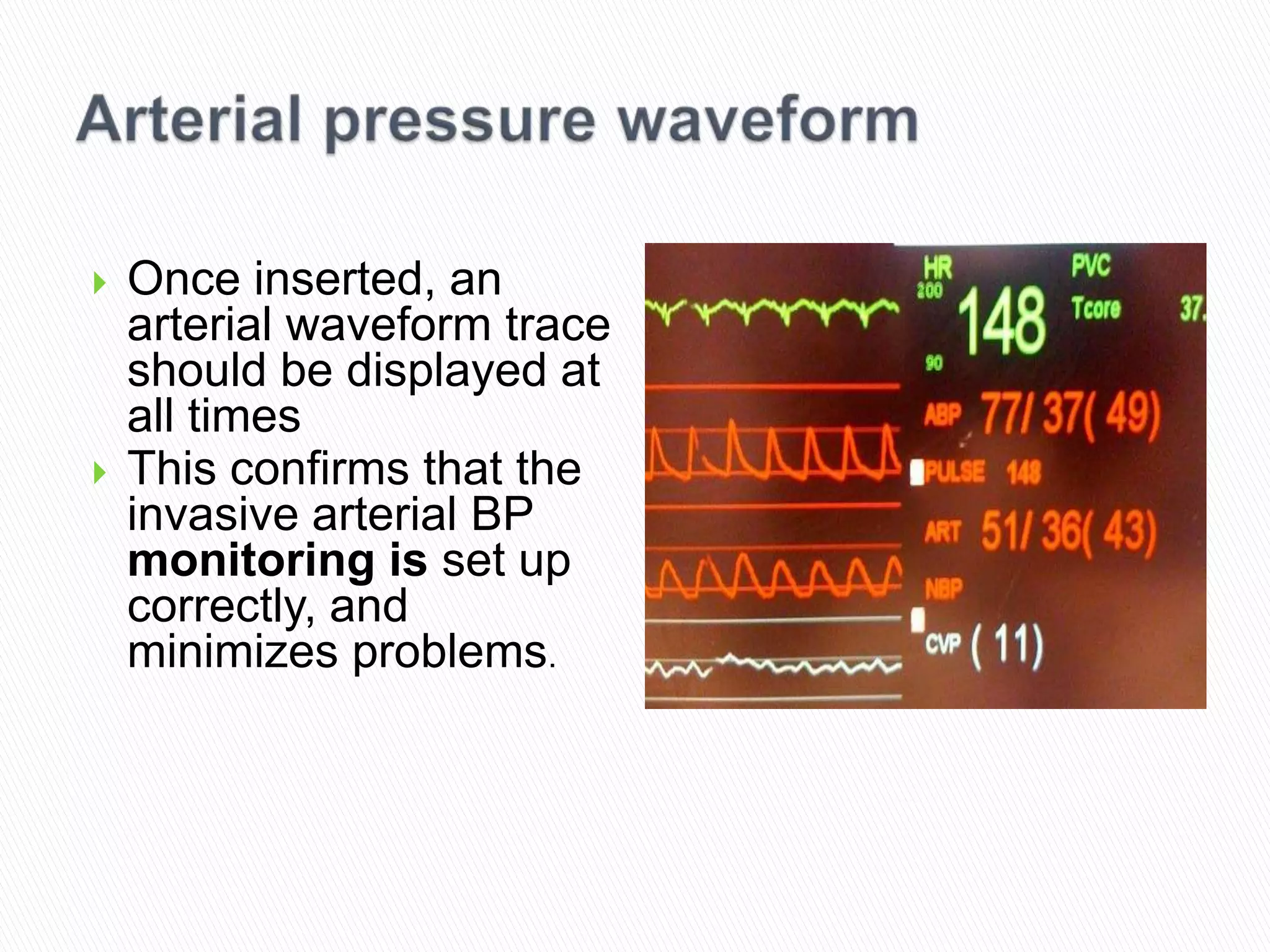 Arterial line insertion | PPTX