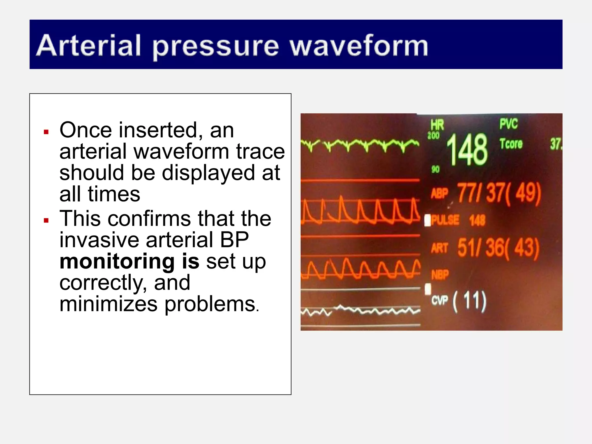 Arterial lines by Dr.Tinku Joseph | PPTX