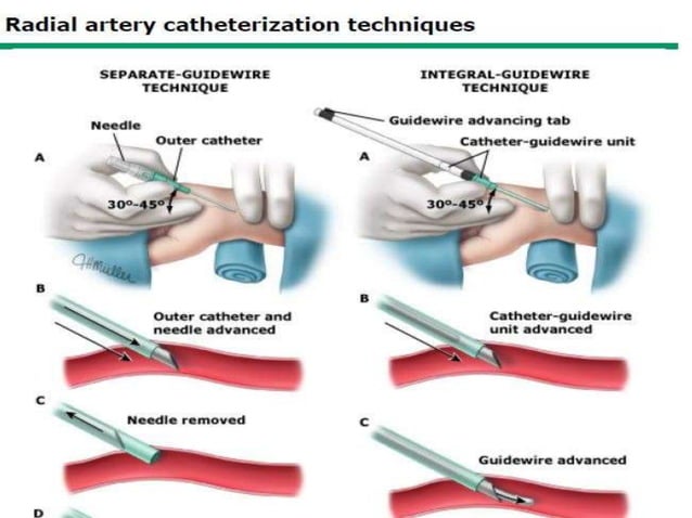 Arterial lines by Dr.Tinku Joseph | PPTX | First Aid | Injuries