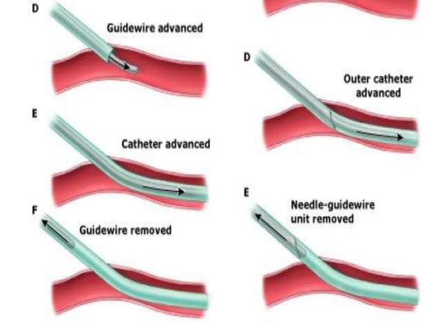 Arterial lines by Dr.Tinku Joseph | PPTX | First Aid | Injuries