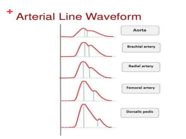 Arterial lines by Dr.Tinku Joseph