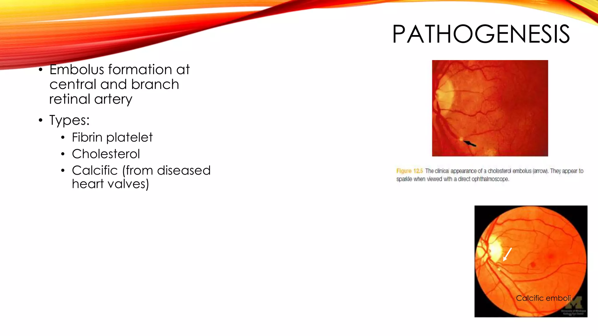 Arterial occlusion | PPTX