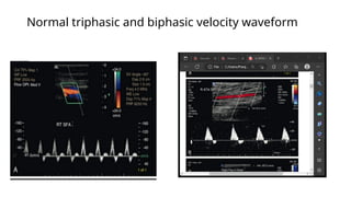 Arterial Physiologic Assessment & Arterial Duplex Scan.pptx