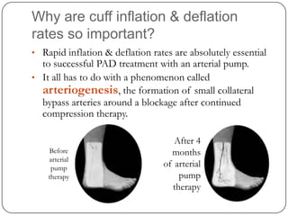 Importance of Arterial Pump Compression & Decompression Rates | PPTX ...