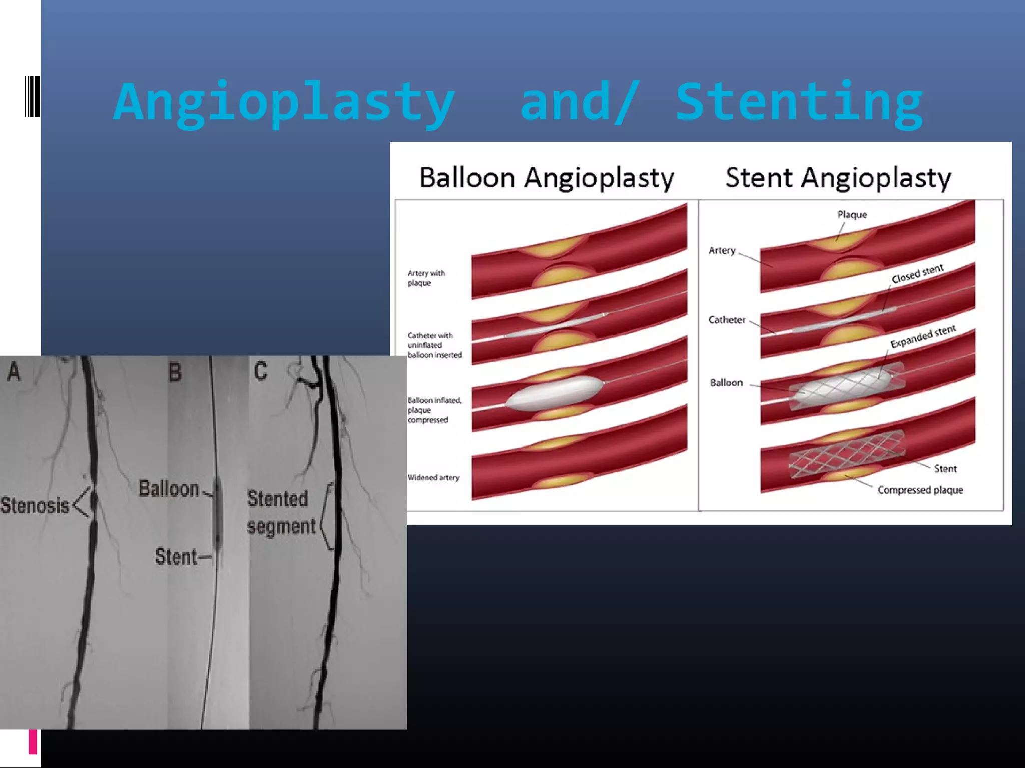 Arterial ulcers by joel arudchelvam | PPT