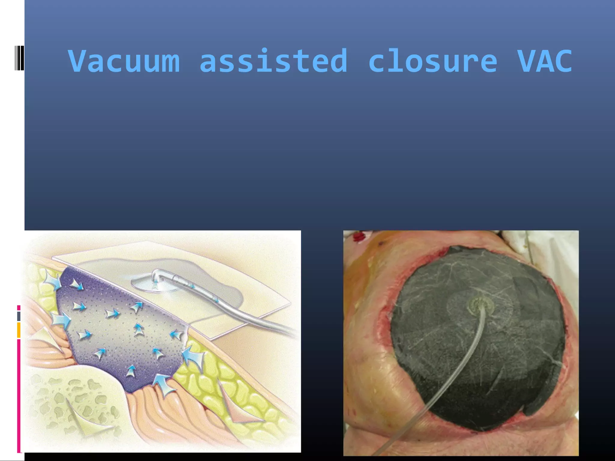 Arterial ulcers by joel arudchelvam | PPT