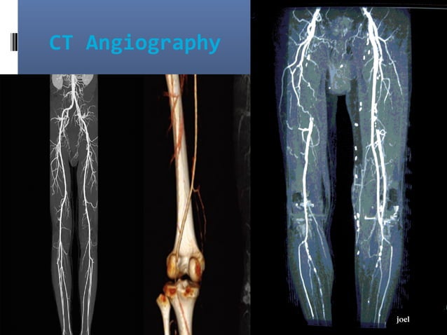 Arterial ulcers by joel arudchelvam | PPT | Skin and Dermatology ...