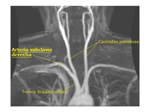Arteria Subclavia