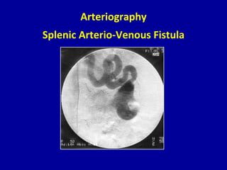 Arterio-Portal Fistula Syndrome (APFS) | PPTX