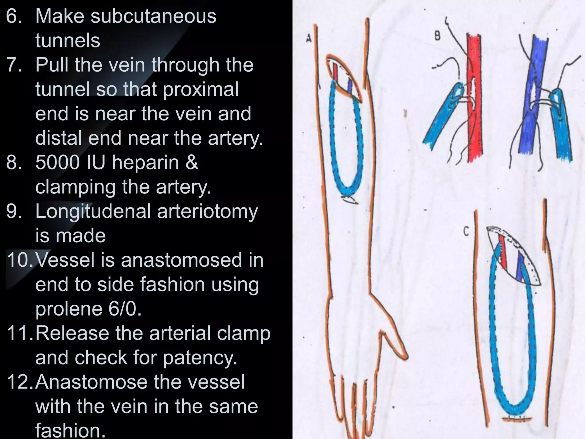 Arterio venous fistulae using grafts | PPTX