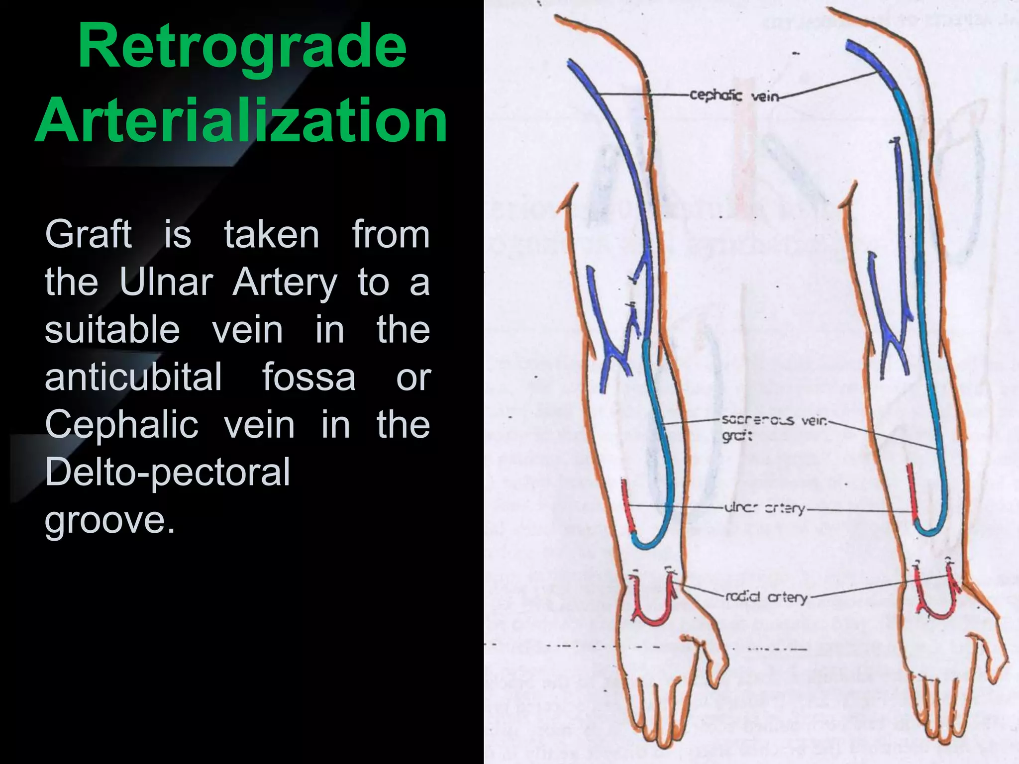 Arterio venous fistulae using grafts | PPTX