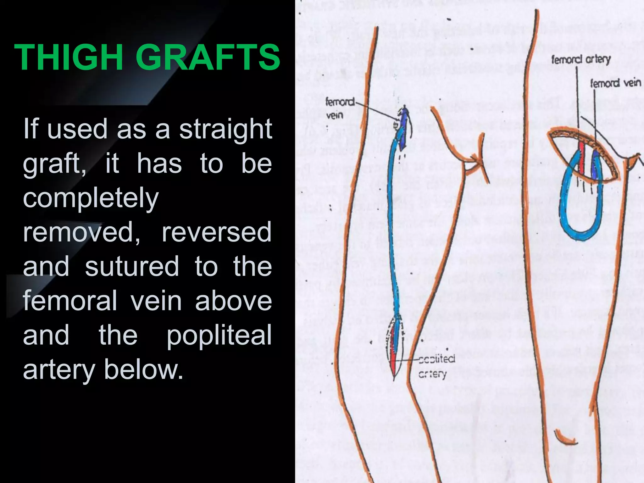 Arterio venous fistulae using grafts | PPTX