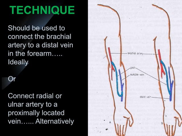 Arterio venous fistulae using grafts | PPT