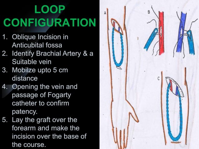 Arterio venous fistulae using grafts | PPT