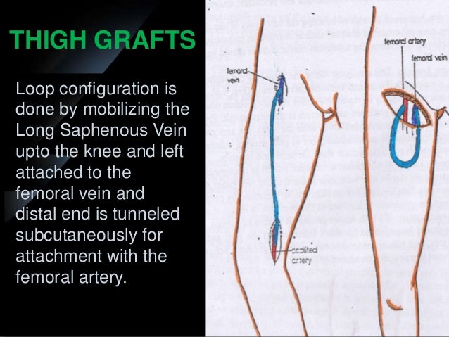 Arterio venous fistulae using grafts
