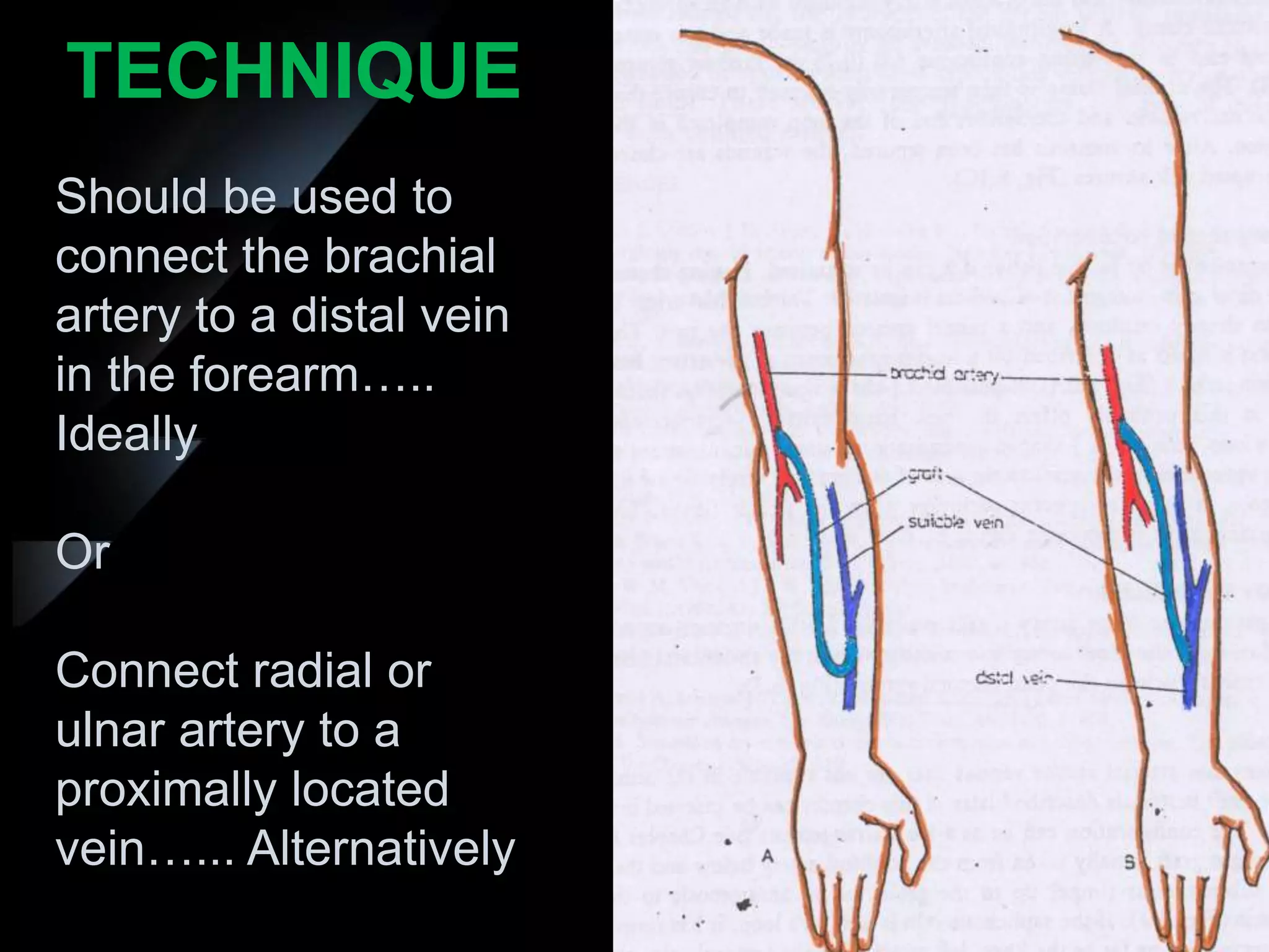 Arterio venous fistulae using grafts | PPTX