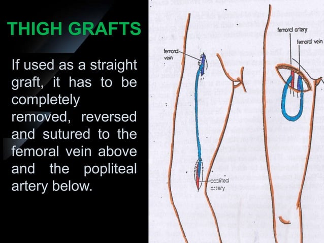 Arterio venous fistulae using grafts | PPT