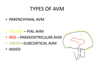 Arterio venous malformation(avm) | PPTX