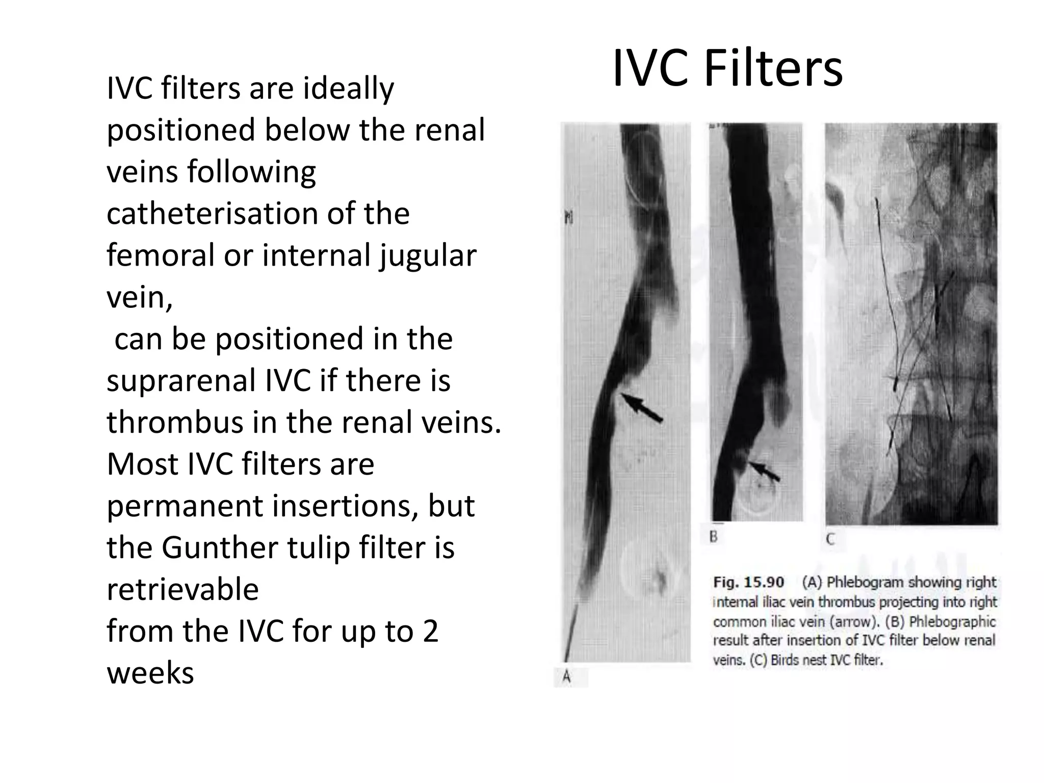 Arteriography and interventional radiology | PPTX