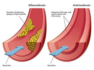 Arteriosclerosis | PPTX