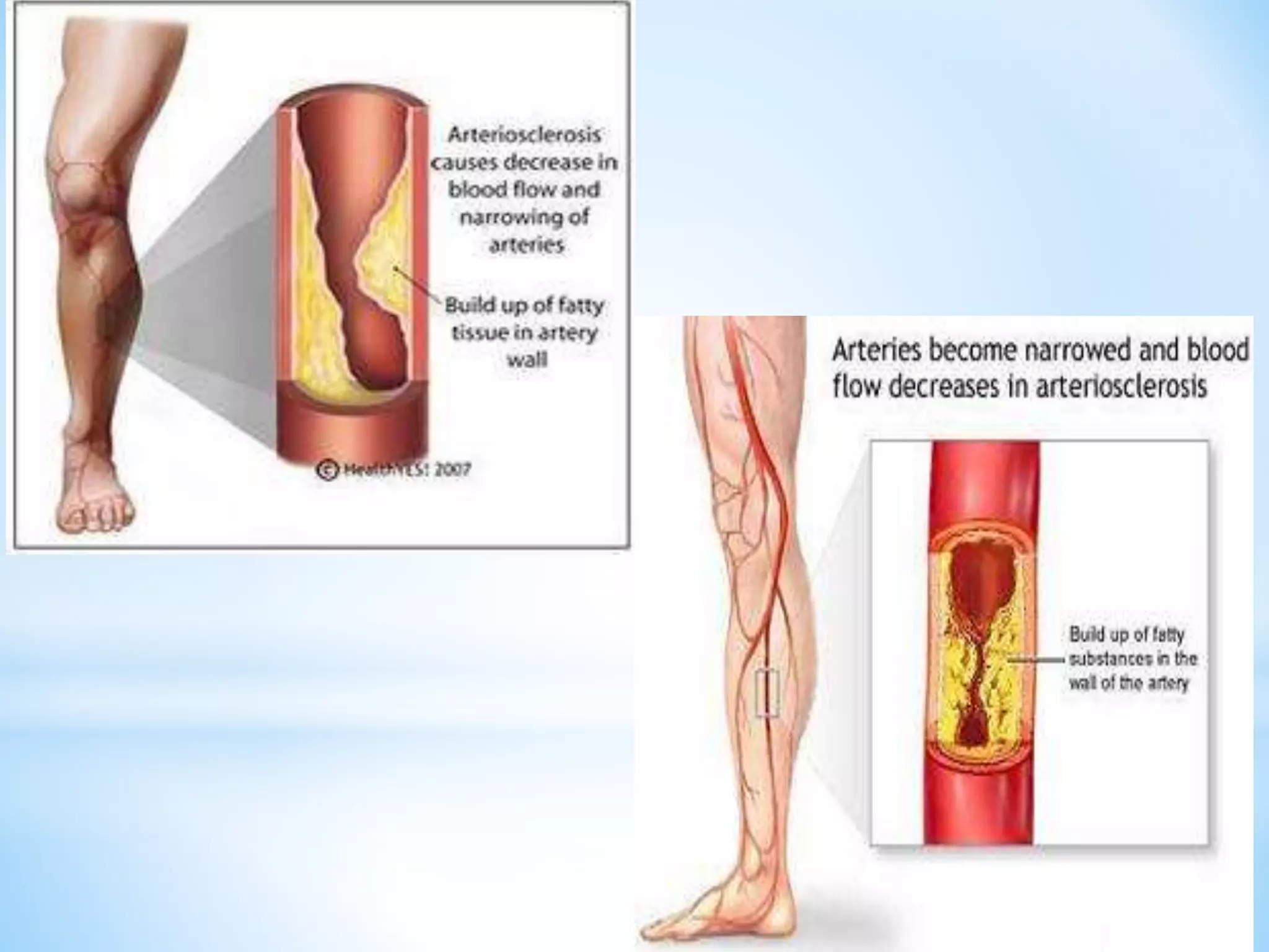 Arteriosclerosisppt