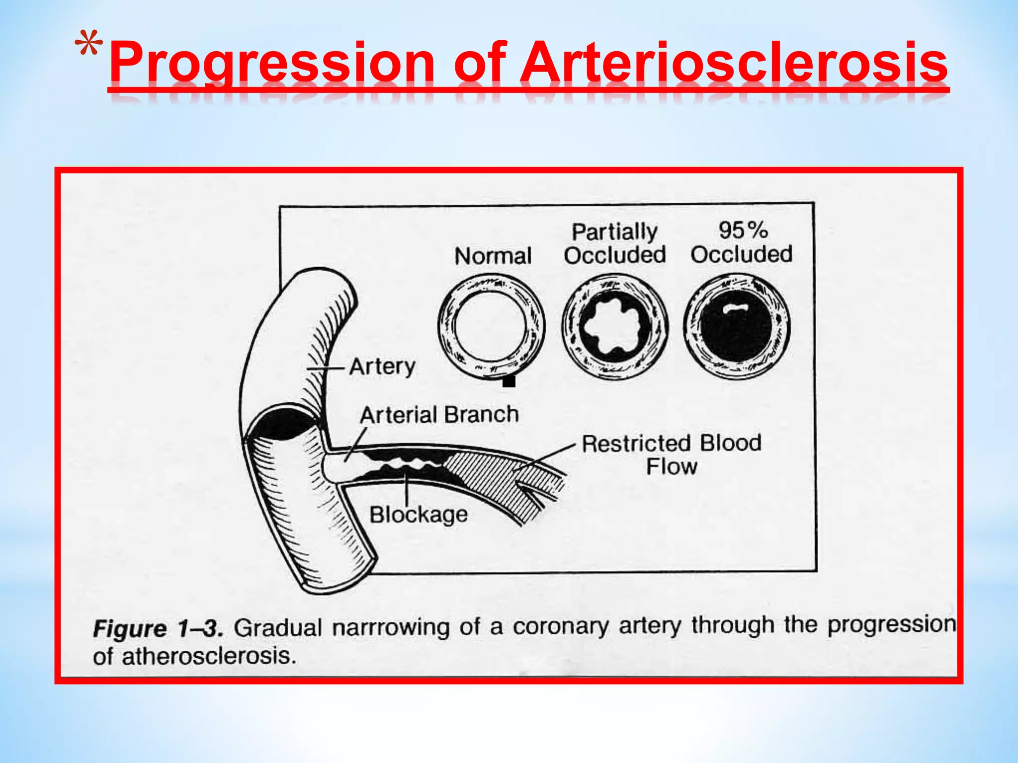 Arteriosclerosis.ppt