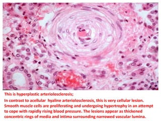 Arteriosclerosis 6 | PPTX