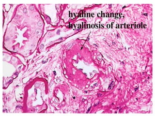 Hyaline Arteriolosclerosis