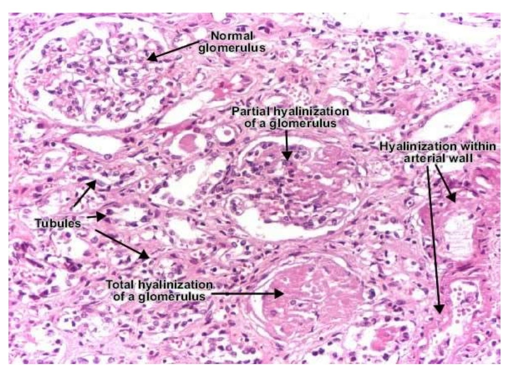 Arteriosclerosis 6
