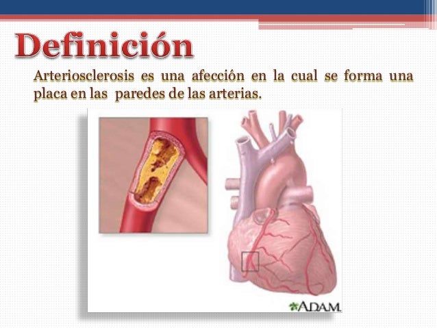 Arteriosclerosis Original