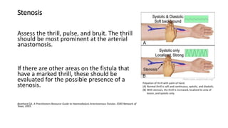 Arterio venous fistula - Reg Lagaac (Cambridge) | PPTX