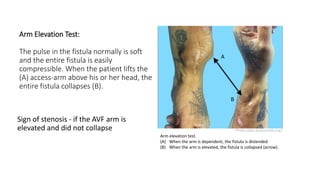 Arterio venous fistula - Reg Lagaac (Cambridge) | PPTX