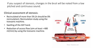 Arterio venous fistula - Reg Lagaac (Cambridge) | PPTX