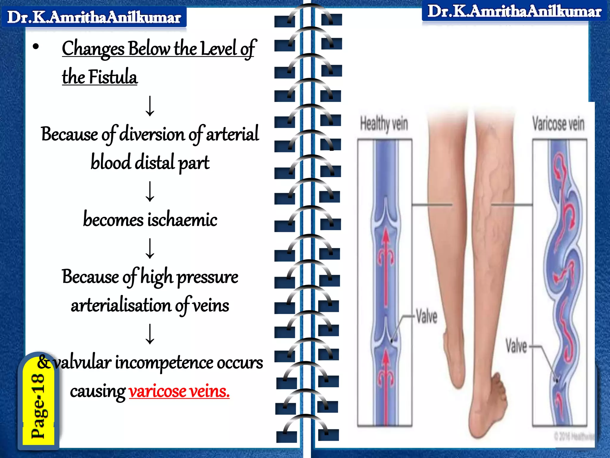 Arterio venous fistula | PPTX