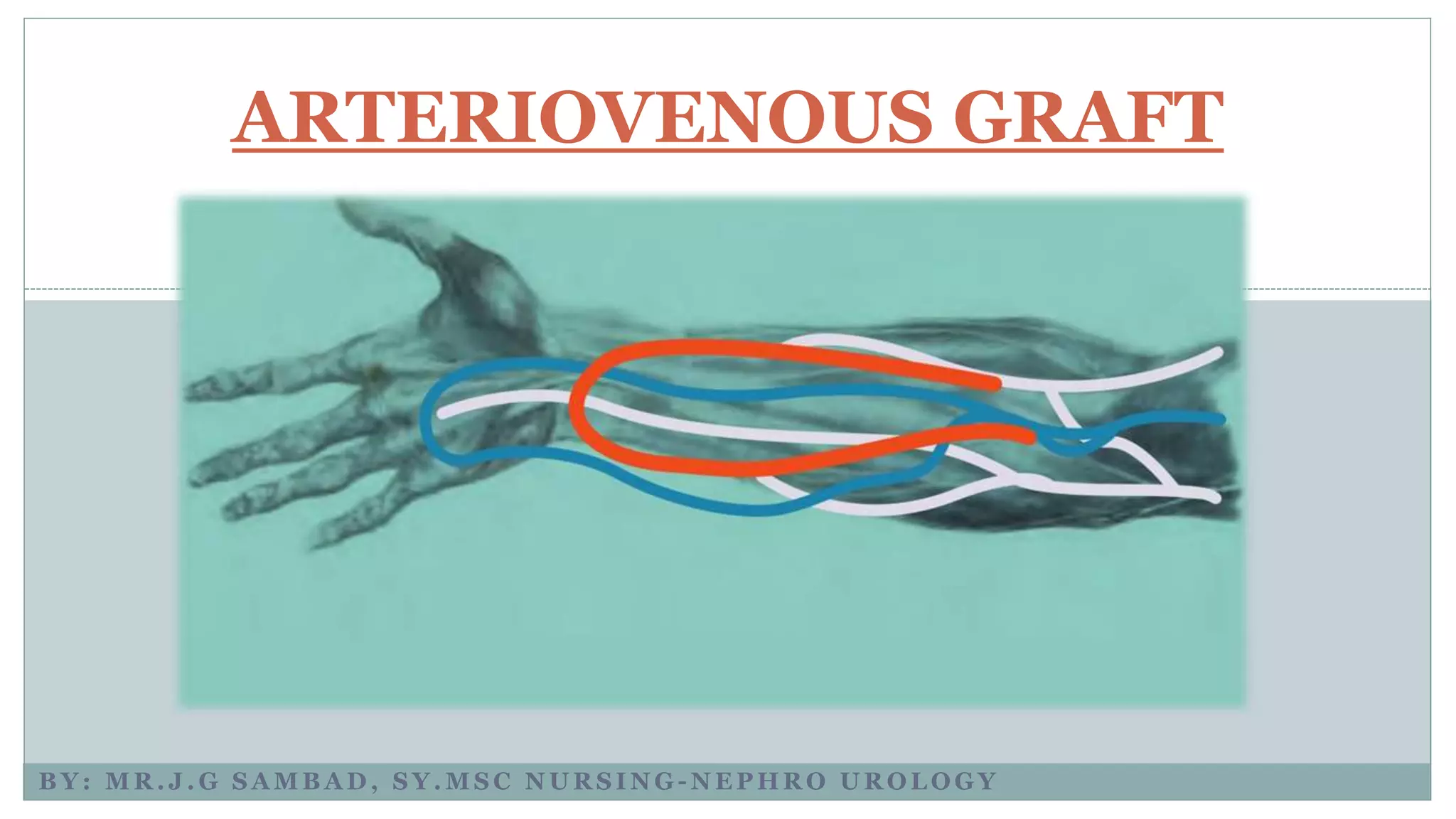 Arteriovenous graft | PPTX