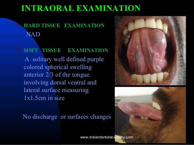 Arteriovenous Malformation Of The Tongue Dental Courses