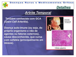 Arterite temporal | PDF