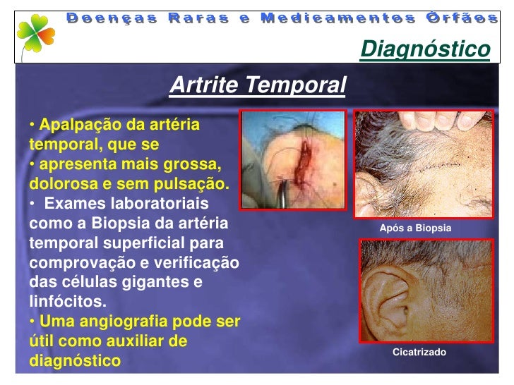Arterite temporal