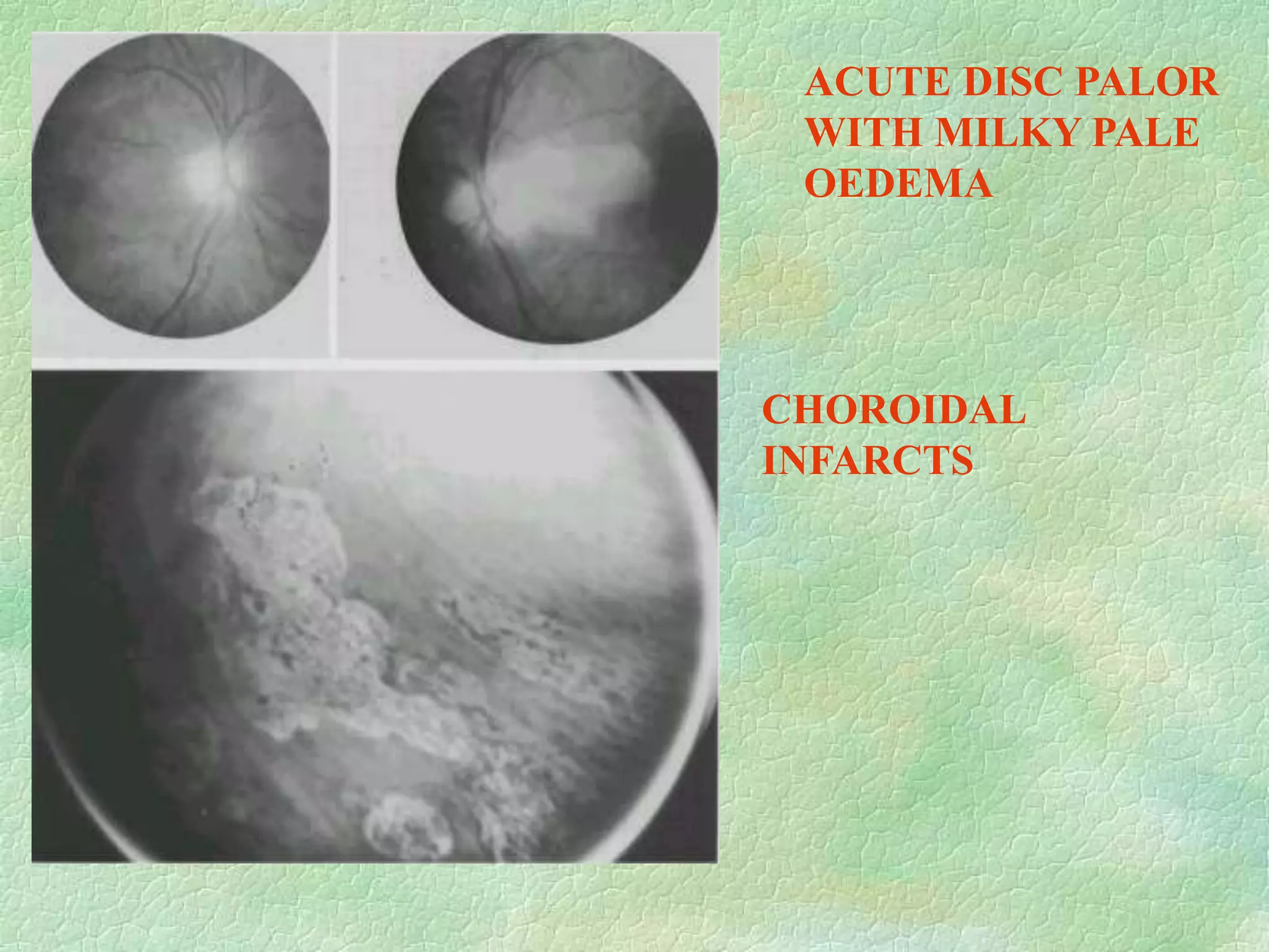 ARTERITIC AION.ppt
