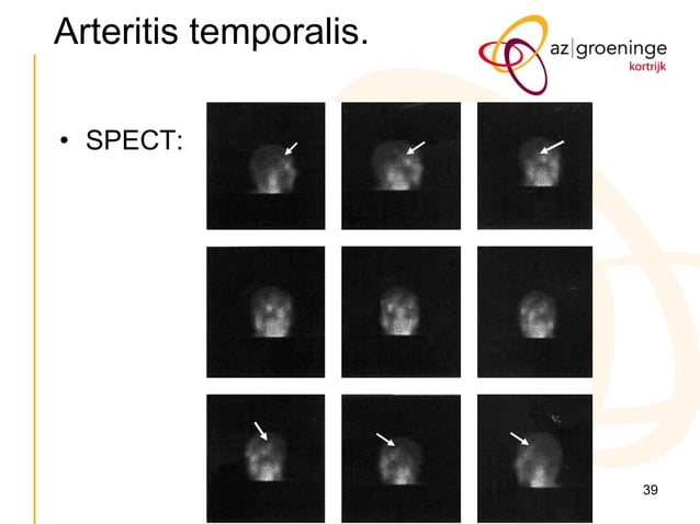 Arteritis temporalis of Total Body Arteritis - Dr. P. Bourgeois | PPT ...