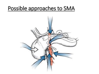 Artery first approach For Pancreatic Head tumours by Dr Harsh Shah (www ...