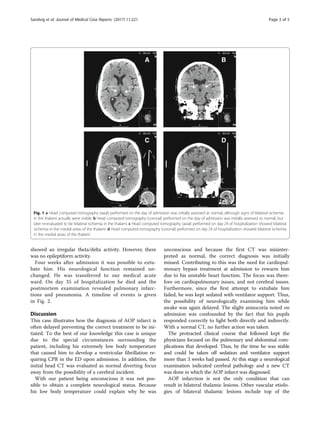 Artery of percheron infarct | PDF