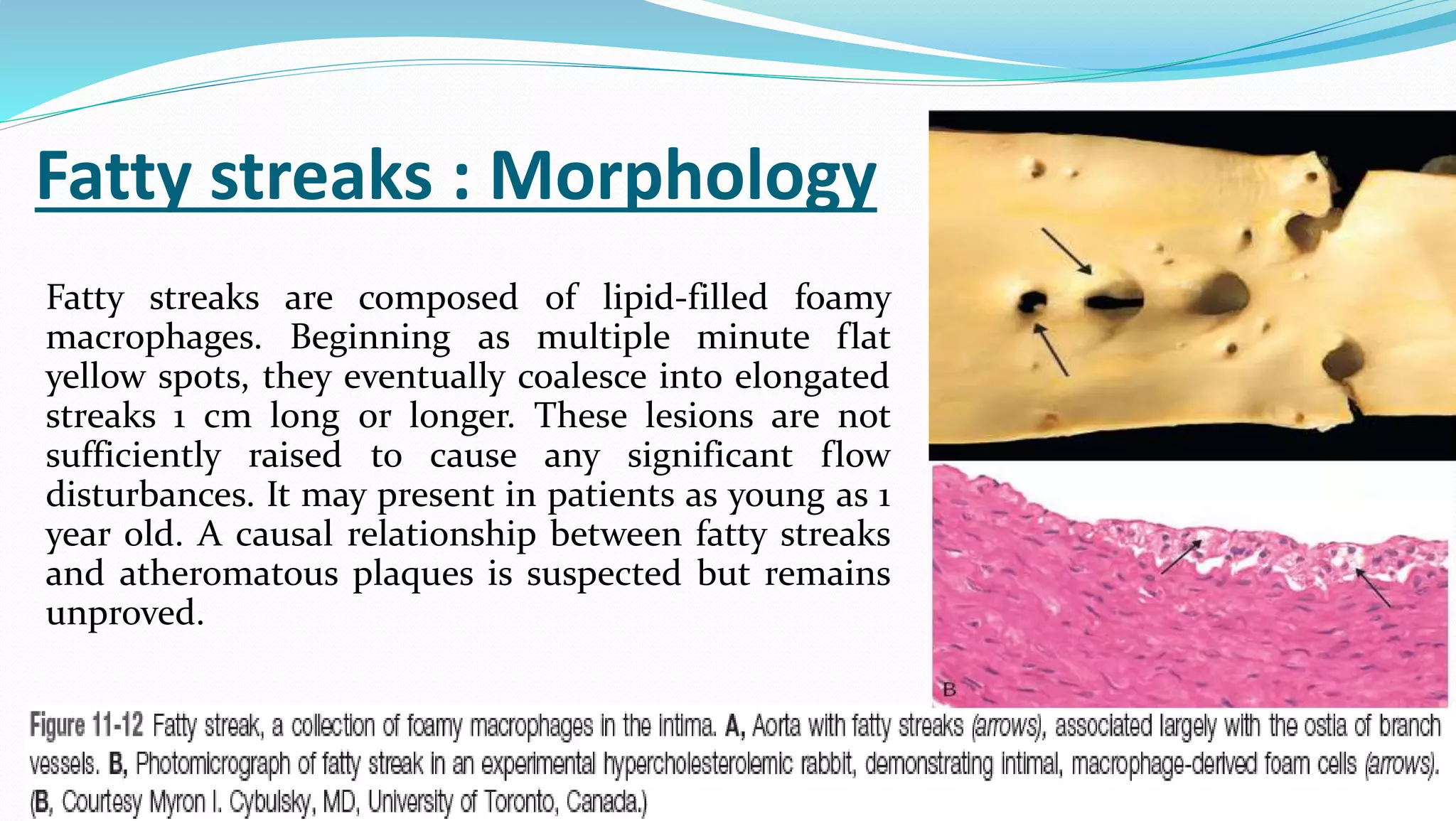 Artherosclerosis | PPTX
