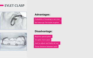 clasps in removable orthodontic appliance | PPTX