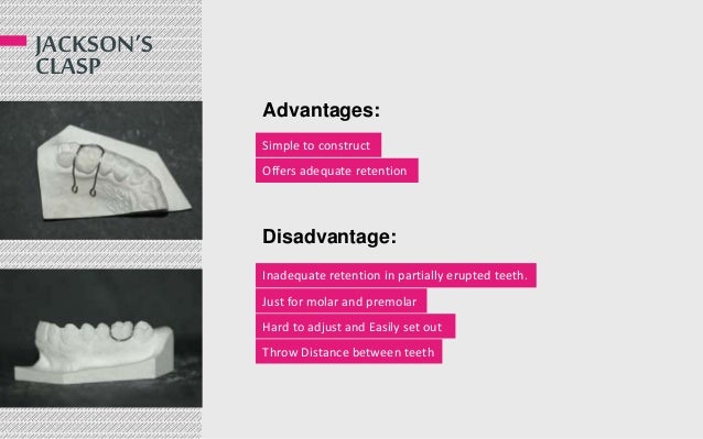 clasps in removable orthodontic appliance