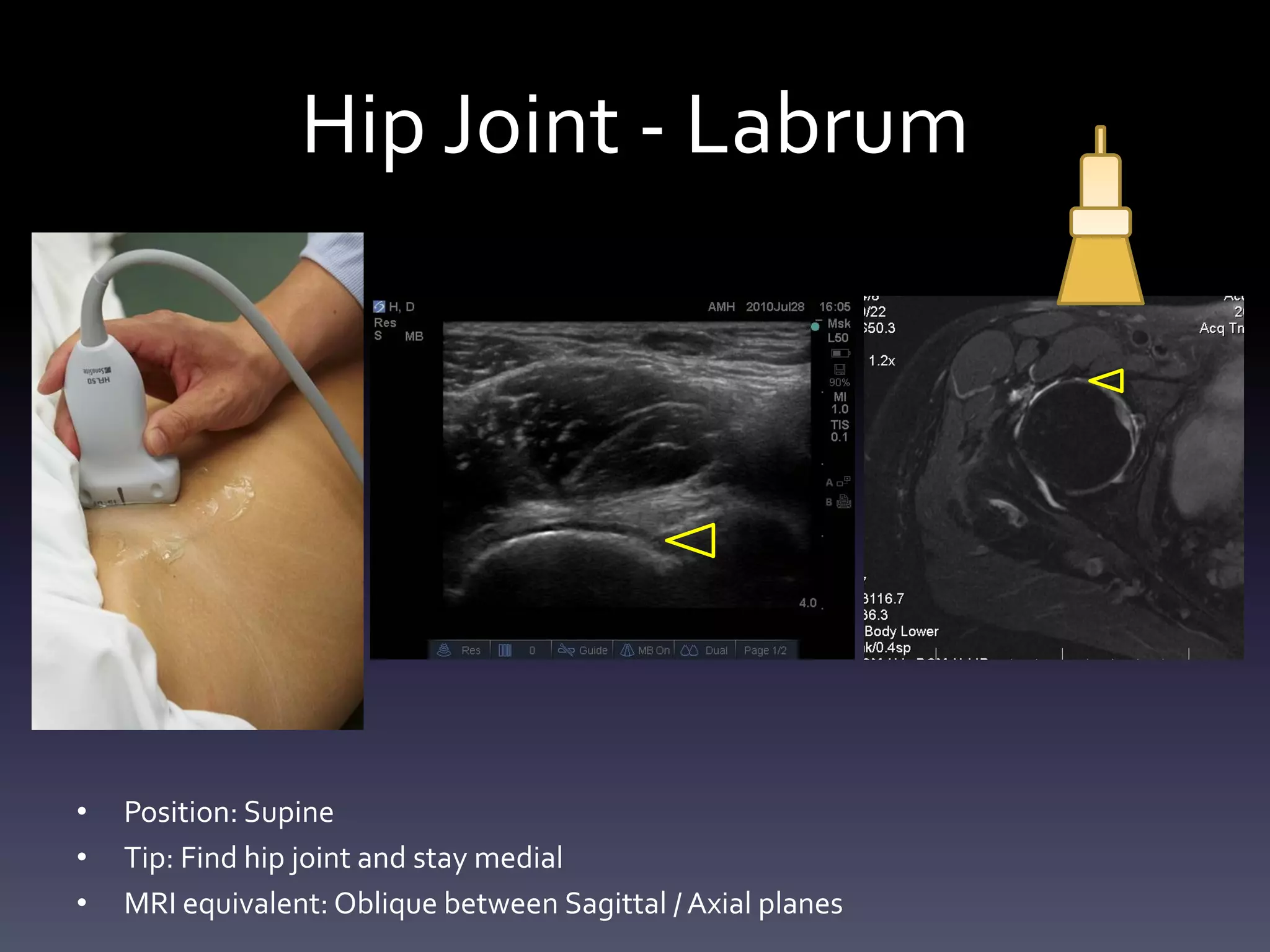 Ultrasound - Hip | PDF